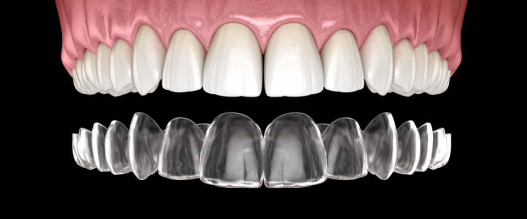 Invisalign® St. Louis | St. Louis Cosmetic Dentistry | Plaza Dental